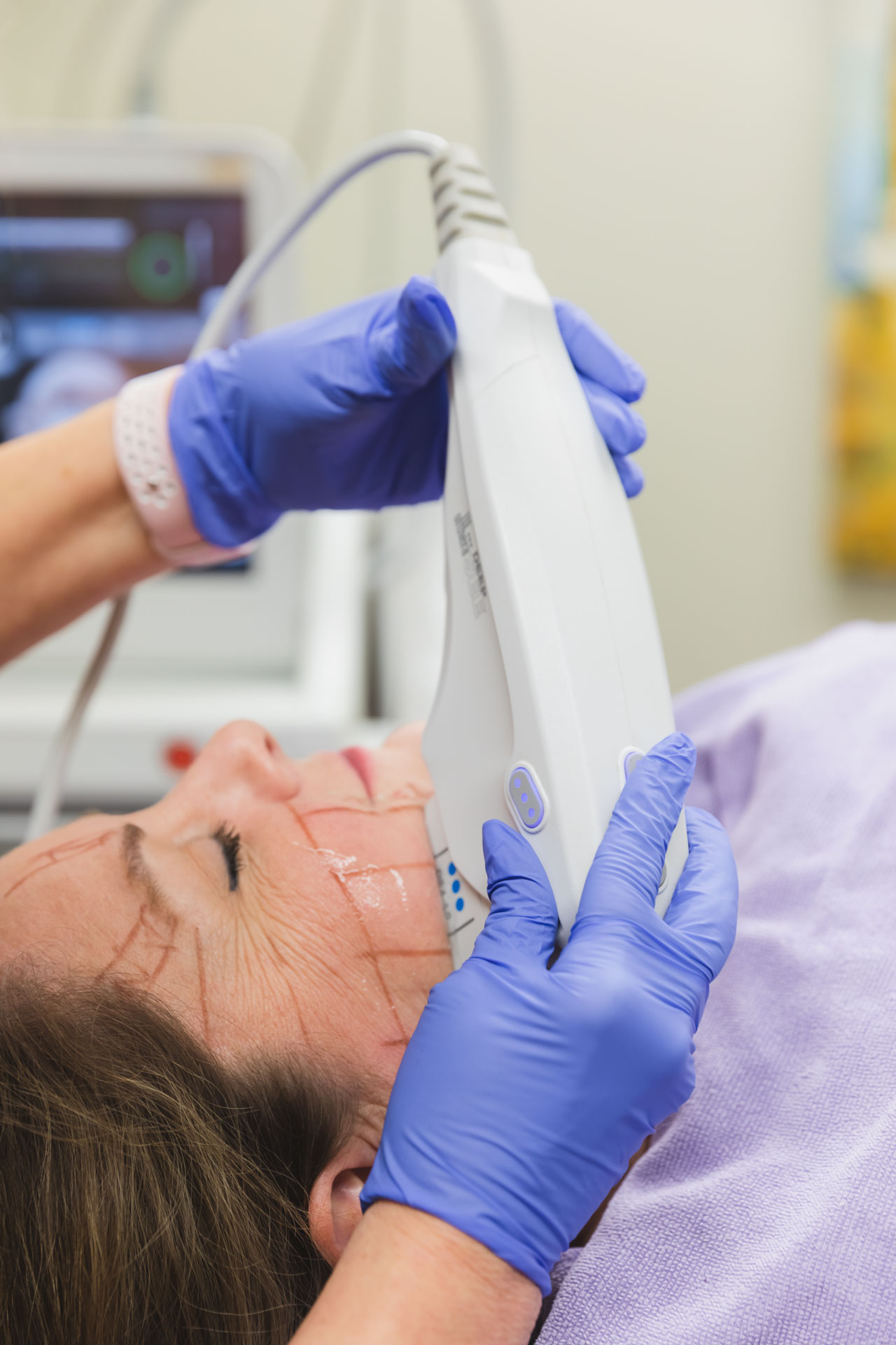 Ultherapy in West Bloomfield Township | the Dr. Susan Seman Solution